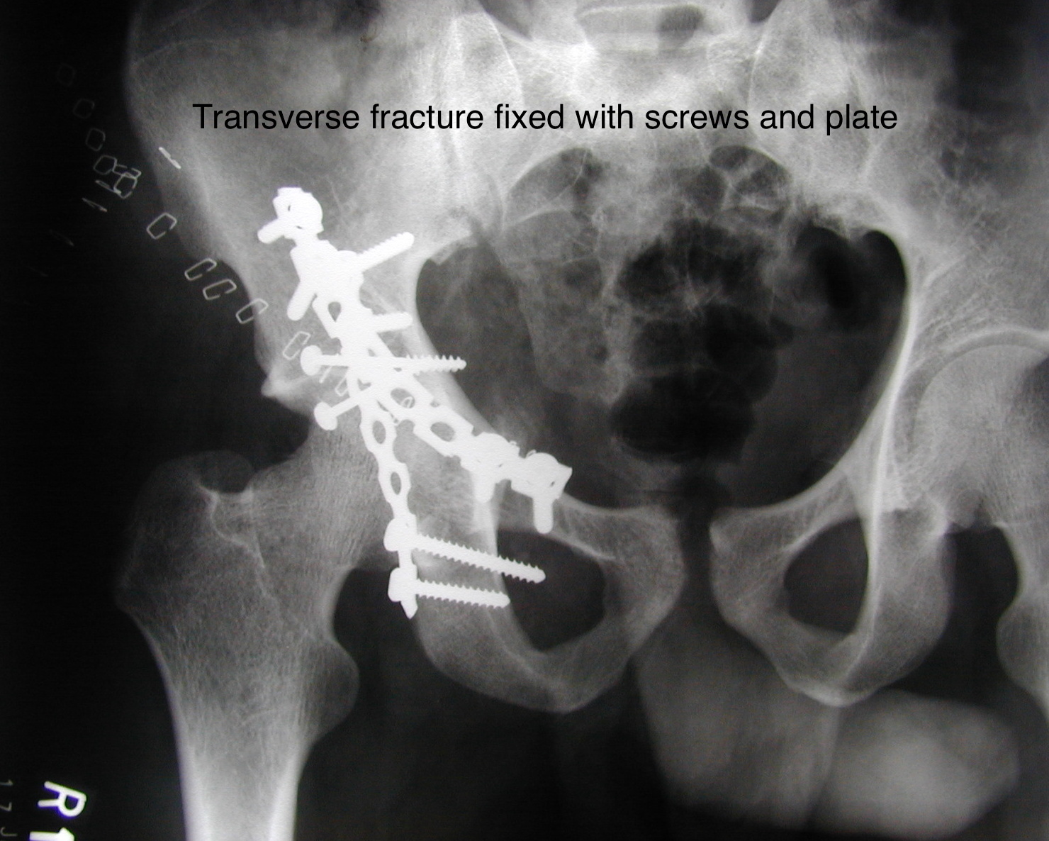 Transverse Fracture Treatment | Transverse Bone Surgery