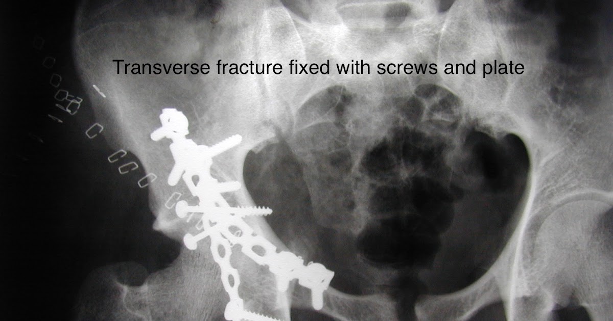 Transverse Fracture Treatment | Transverse Bone Surgery