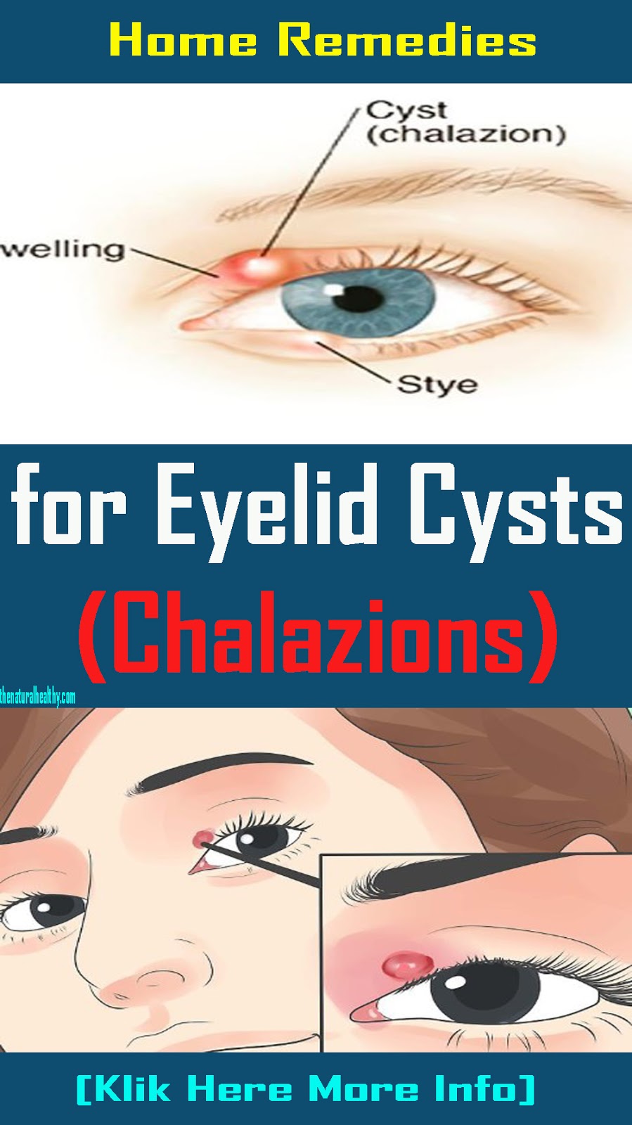 Eyelid Cyst Chalazion Causes Symptoms Treatment Eyelid Cyst