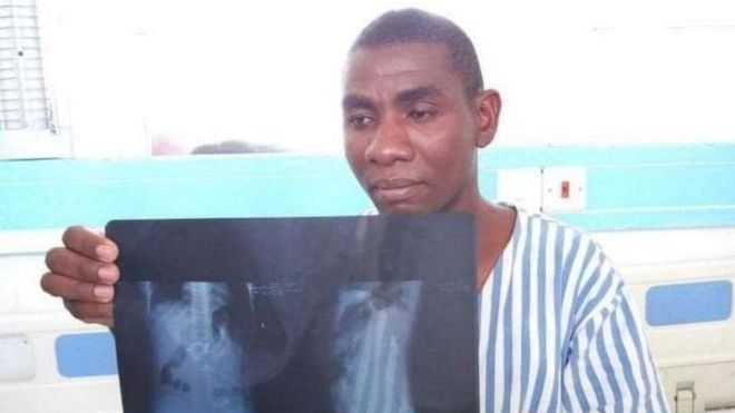 Mwanaume atolewa mswaki tumboni Kenya - KILOLE MZEE BLOG