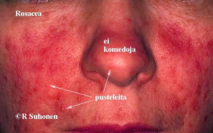 Tavoitteena terve iho: Aknea muistuttavia ihosairauksia