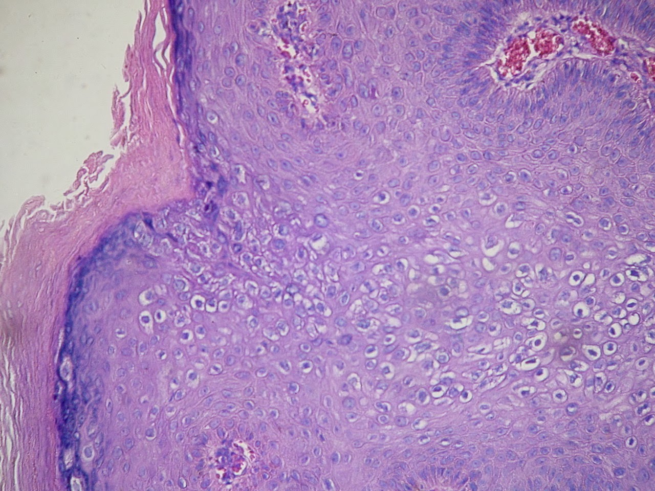 dermatopatologia para iniciantes: Dezembro 2013