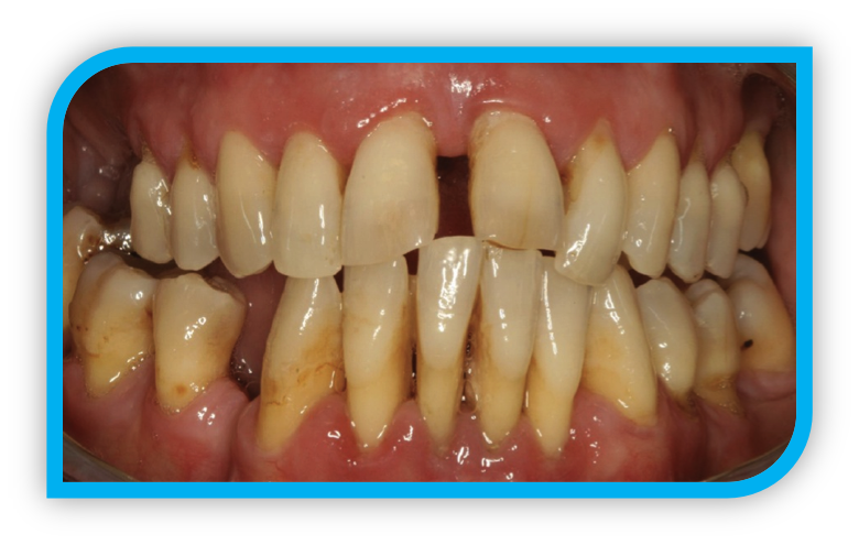 CLASIFICACIÓN DE LAS ENFERMEDADES Y CONDICIONES PERIODONTALES ...