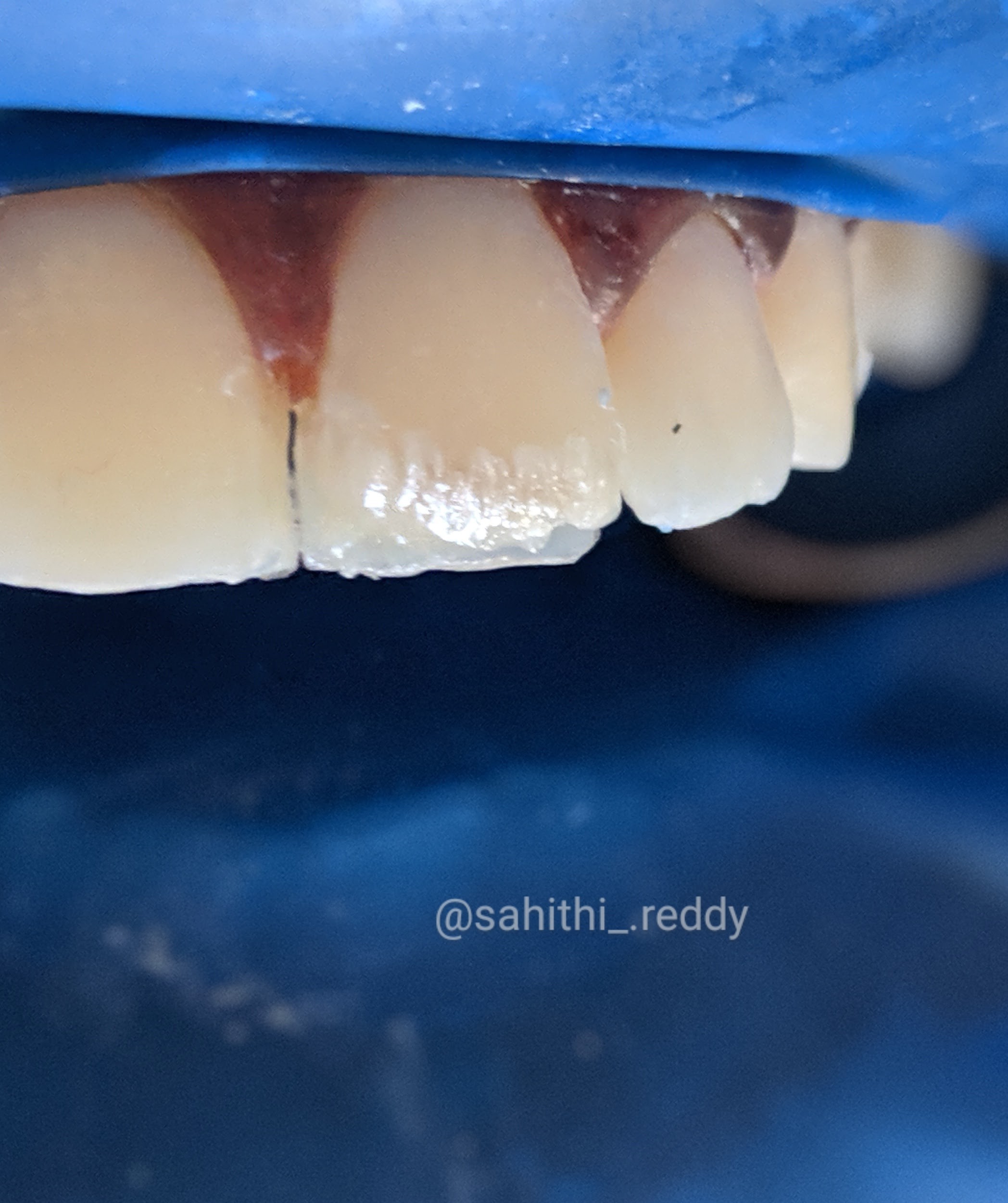 BIO-EMULATION with composite resin