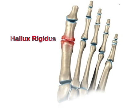 Clínica e Cirurgia do Pé e Tornozelo: Hallux Rigidus