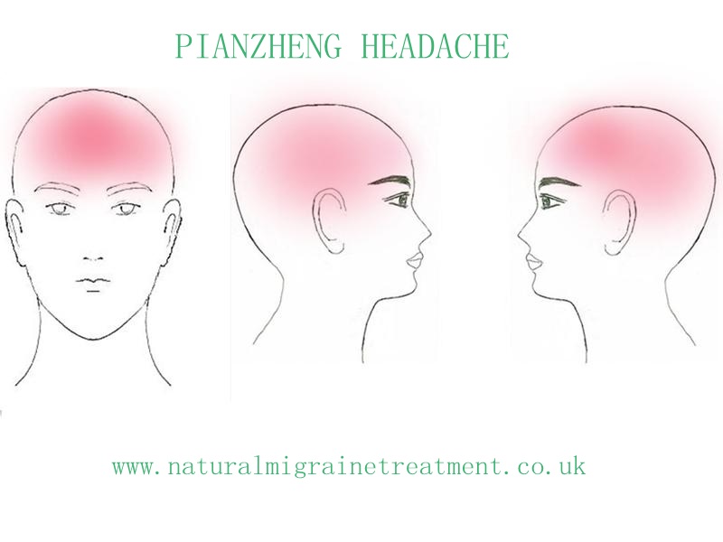 Natural Migraine Treatment: The 6 different types of Migraine related ...