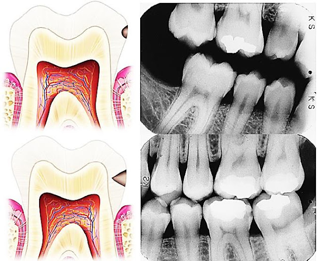 Dental caries l Oral radiology MCQs for dental students - WikiDentia