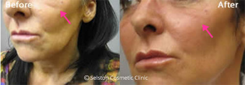 Selston Cosmetic Clinic: Restore Volume to Sunken Cheeks With Dermal ...