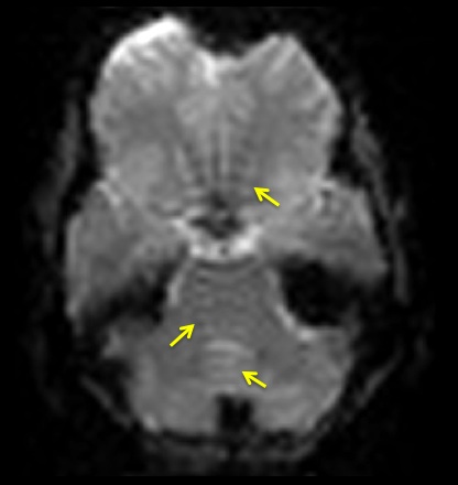 practiCal fMRI: the nuts & bolts: Common persistent EPI artifacts ...