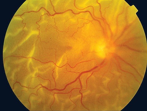 Askep Ablasio Retina atau Retinal Detachment - Repro Note