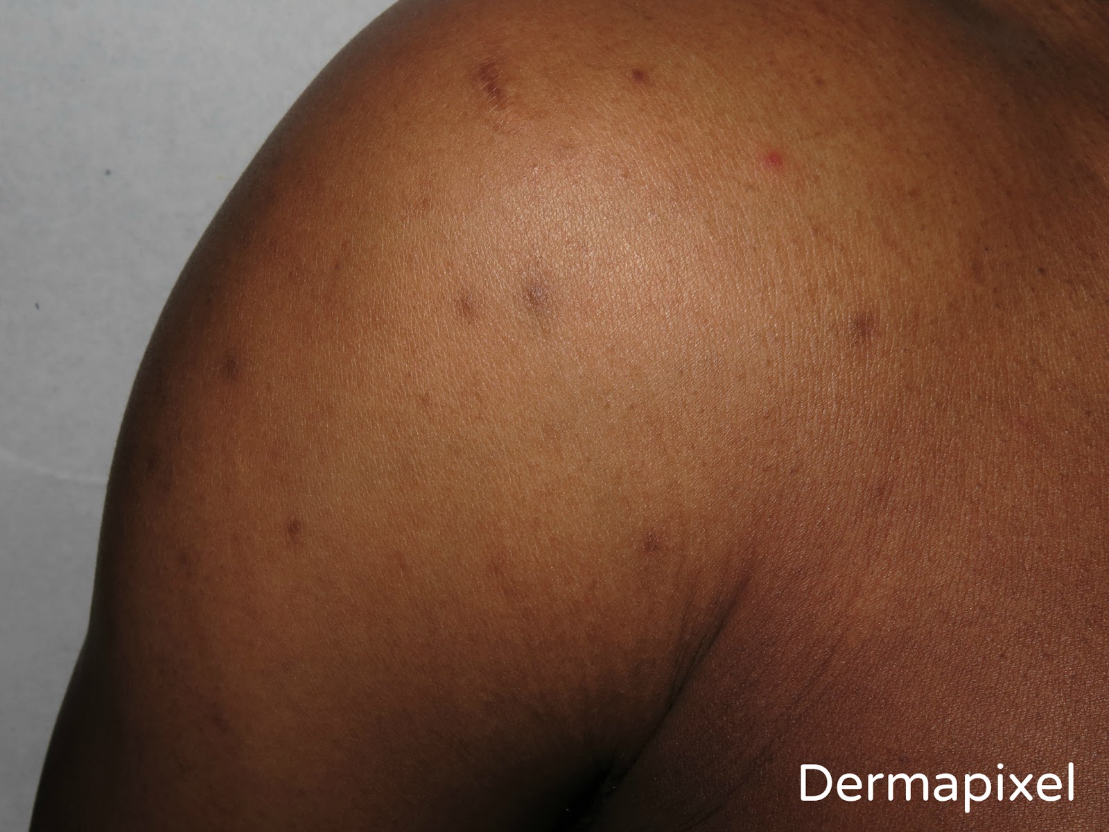 Dermapixel: julio 2017