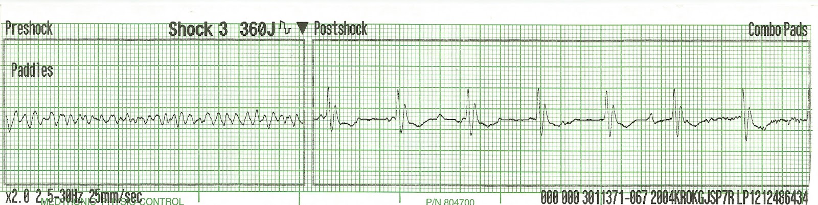 Code Blue: Refractory Ventricular Fibrillation