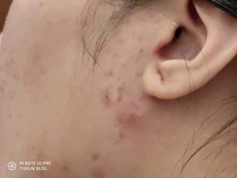 Review Enhaka Serum Acne Care Premium - Kisah Foto