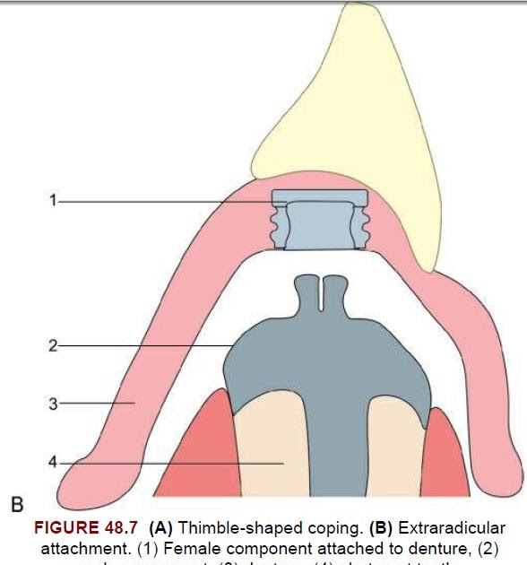 Over denture and attachment-retained dentures 2 l Prosthodontics MCQs ...