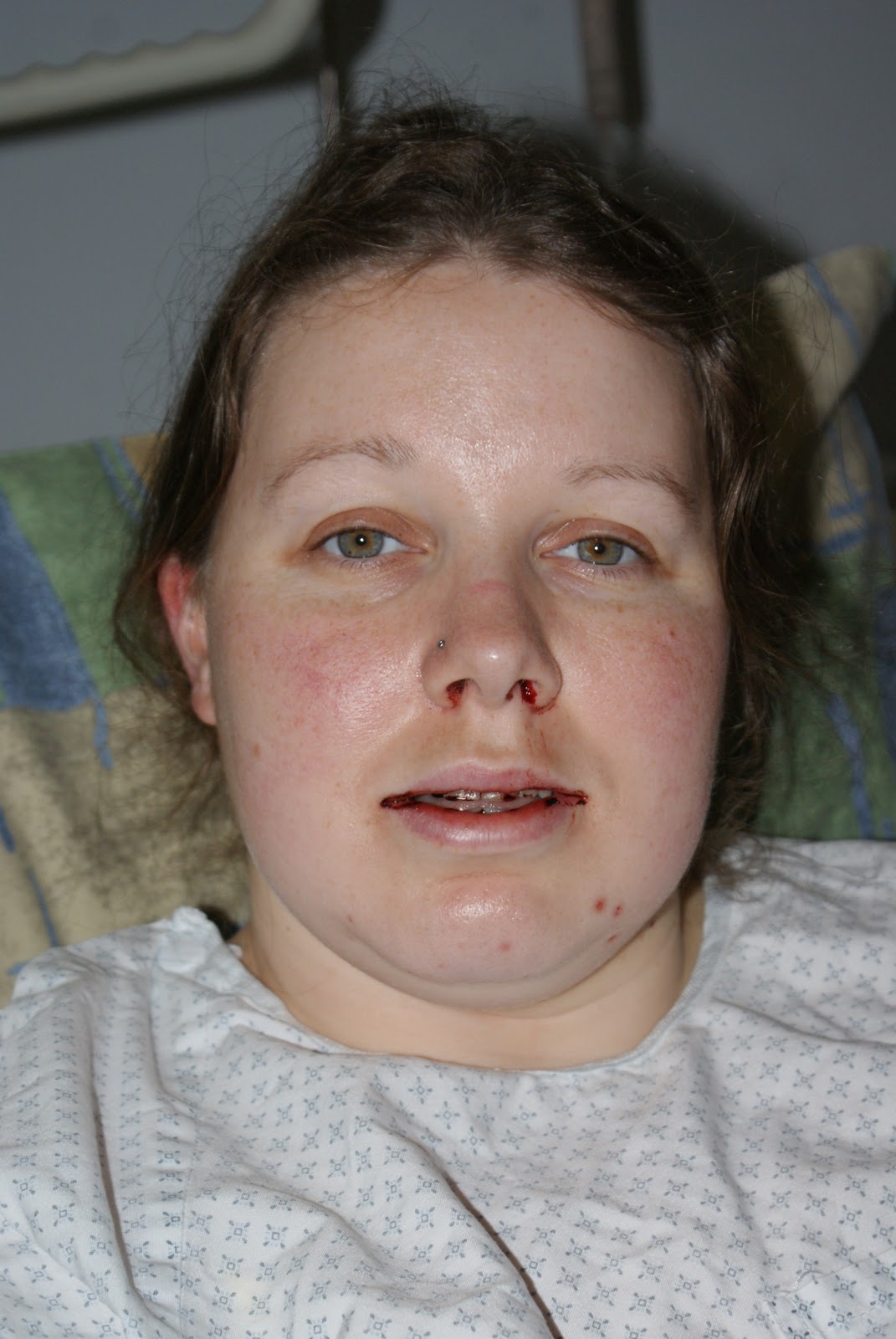 Braces + SARPE/SARME Surgery