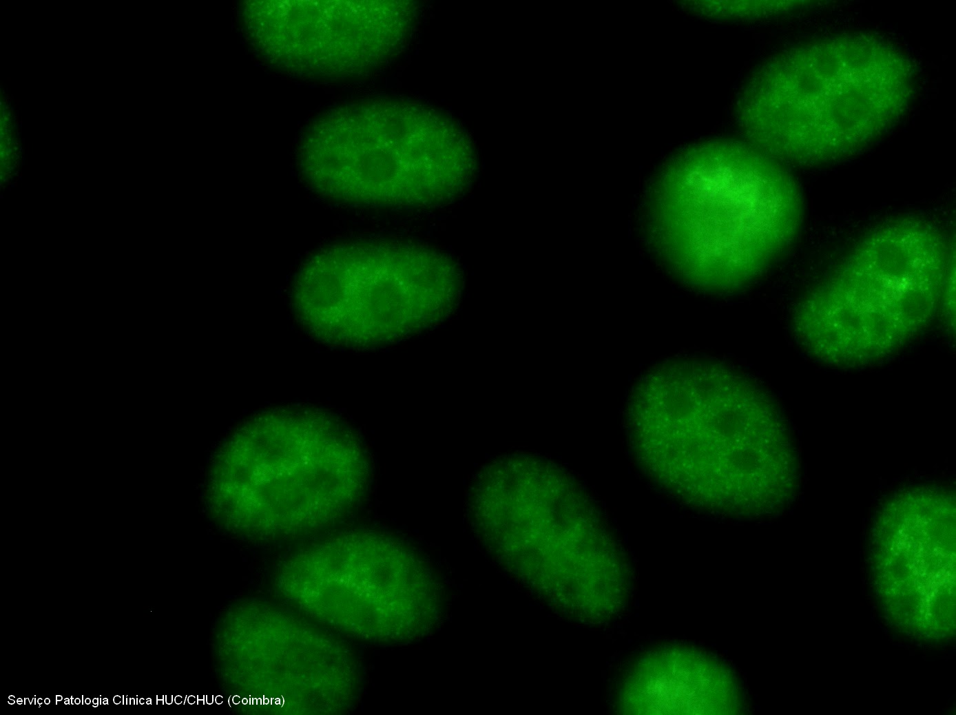 Anticorpos anti - SSA (Ro) e anti - SSB (La)