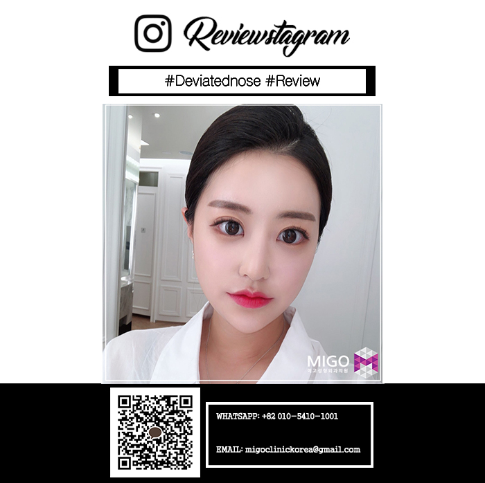 MIGO NOSE | DEVIATED NOSE