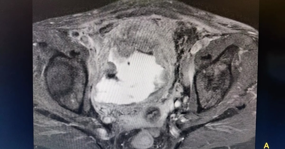 MRI Female BLADDER MASSES and MITOTIC