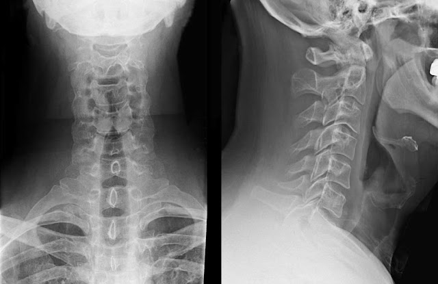 Cervical Spine Radiographs in the Trauma Patient