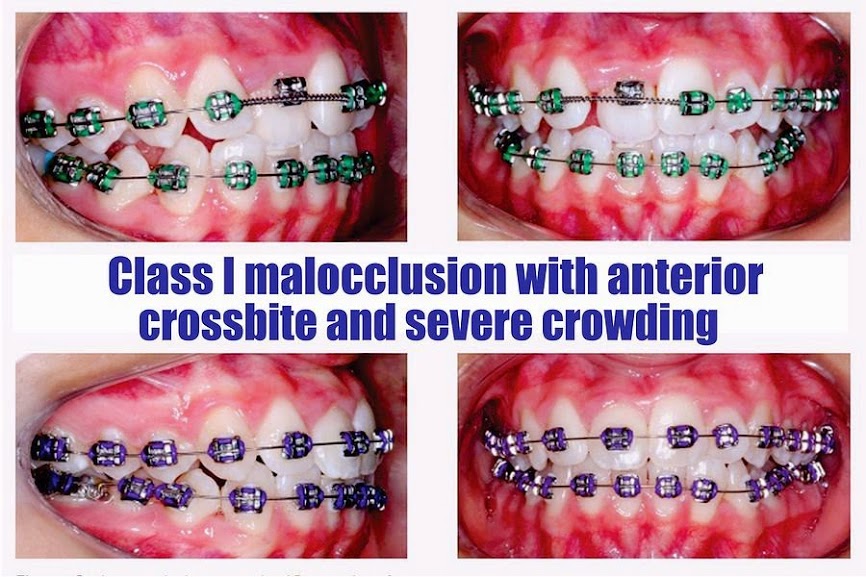 CLINICAL CASE: Class I malocclusion with anterior crossbite and severe ...