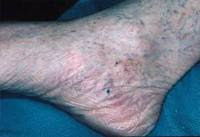 Avoid Vein Bleeding By Seeking Early Evaluation | CVL Blog