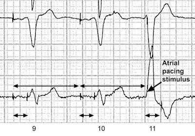 Focus on ECGs: Case #1 - Pacing on the T Wave: What Is the Cause?