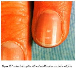 Nail Diseases: White Nails Disease