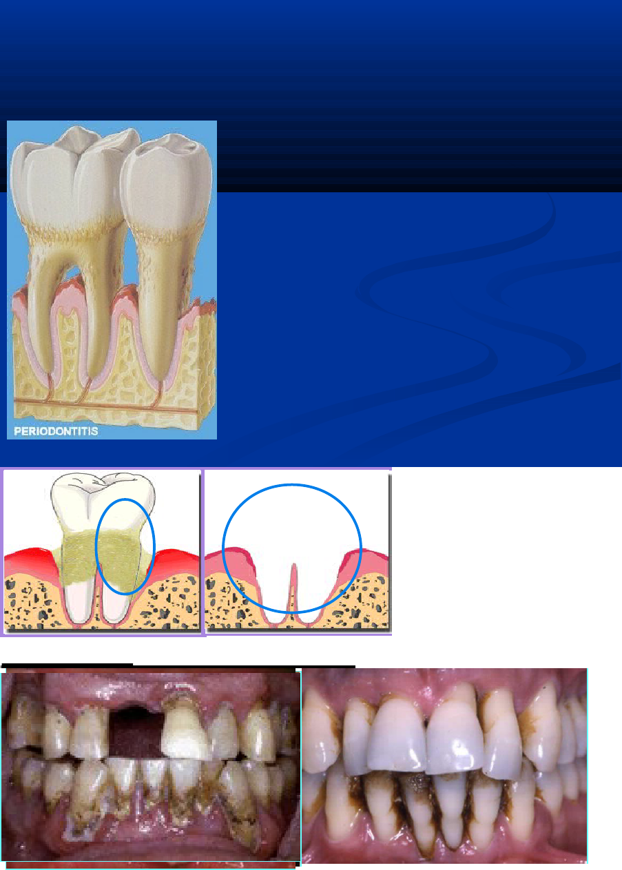 ENFERMEDAD PERIODONTAL