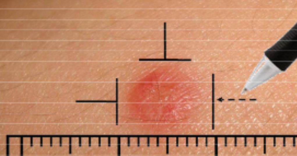 PRUEBAS DIAGNÓSTICAS: Prueba de tuberculina