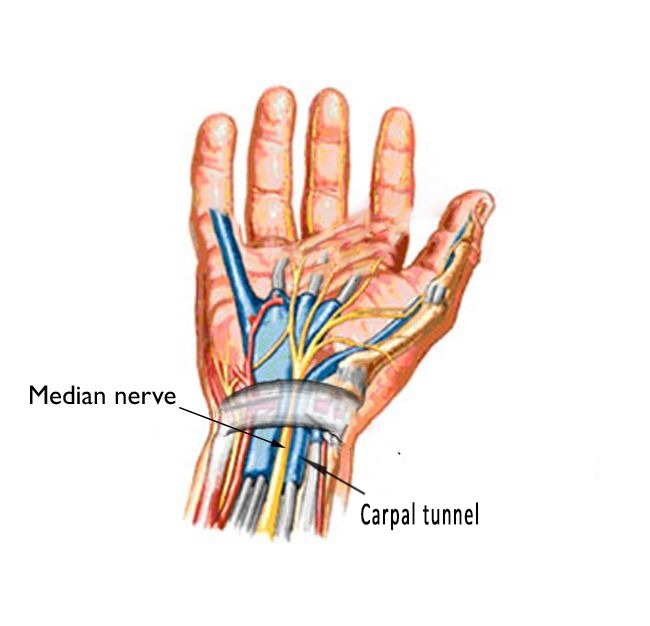 Carpal Tunnel Syndrome