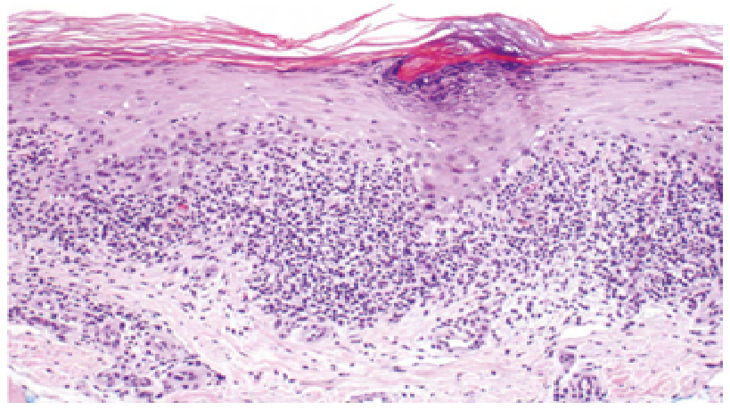 Atlas virtual de histologia e patologia: [CC II: #3] LÍQUEN PLANO