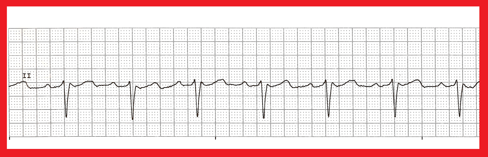 Basic EKG Rhythm Test 21 (Heart Block Challenge)