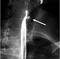 Protocolos De Imagenologia: ESOFAGOGRAMA