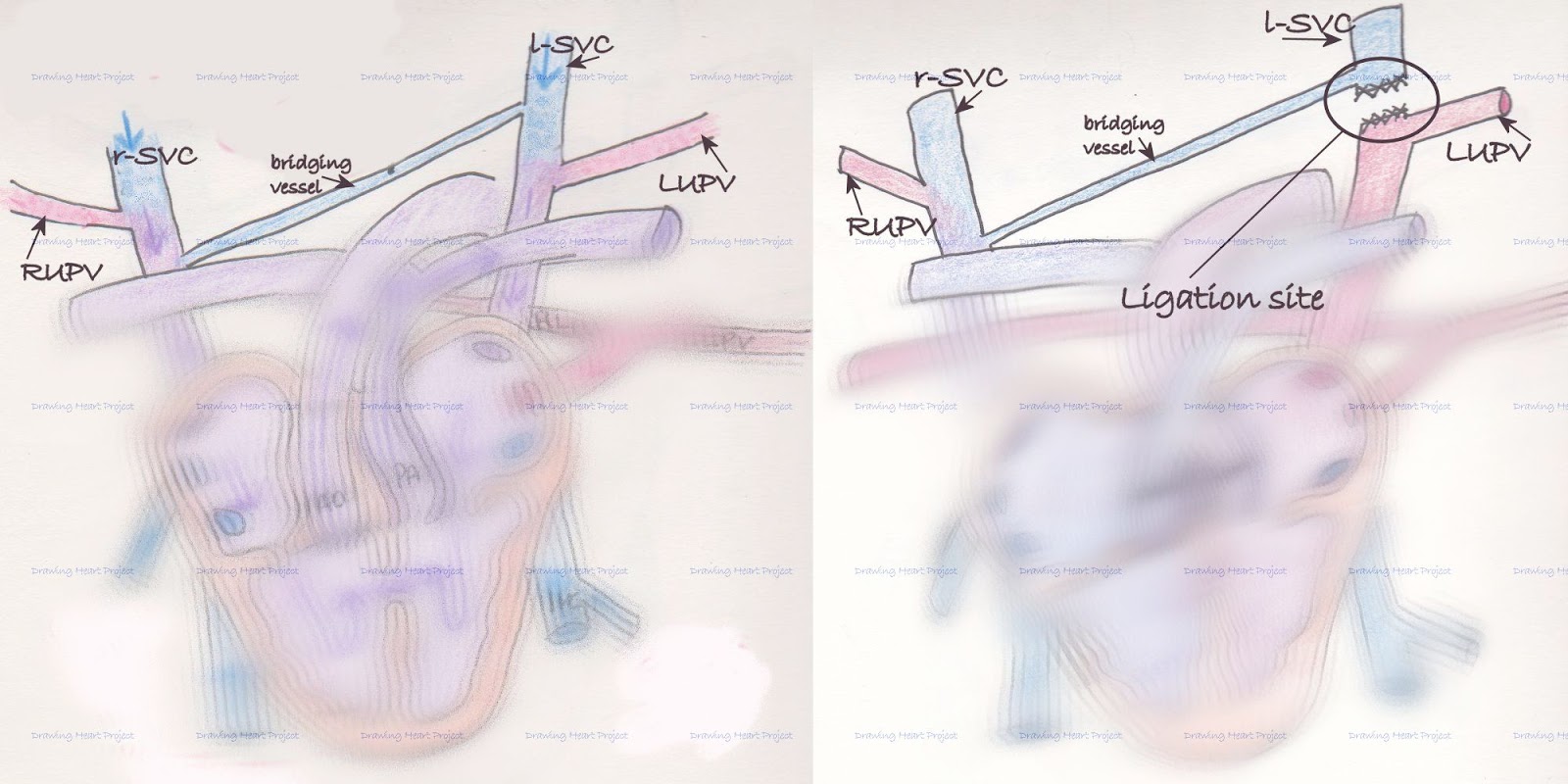 Drawing Heart: His first surgical repair - the Jatene Procedure