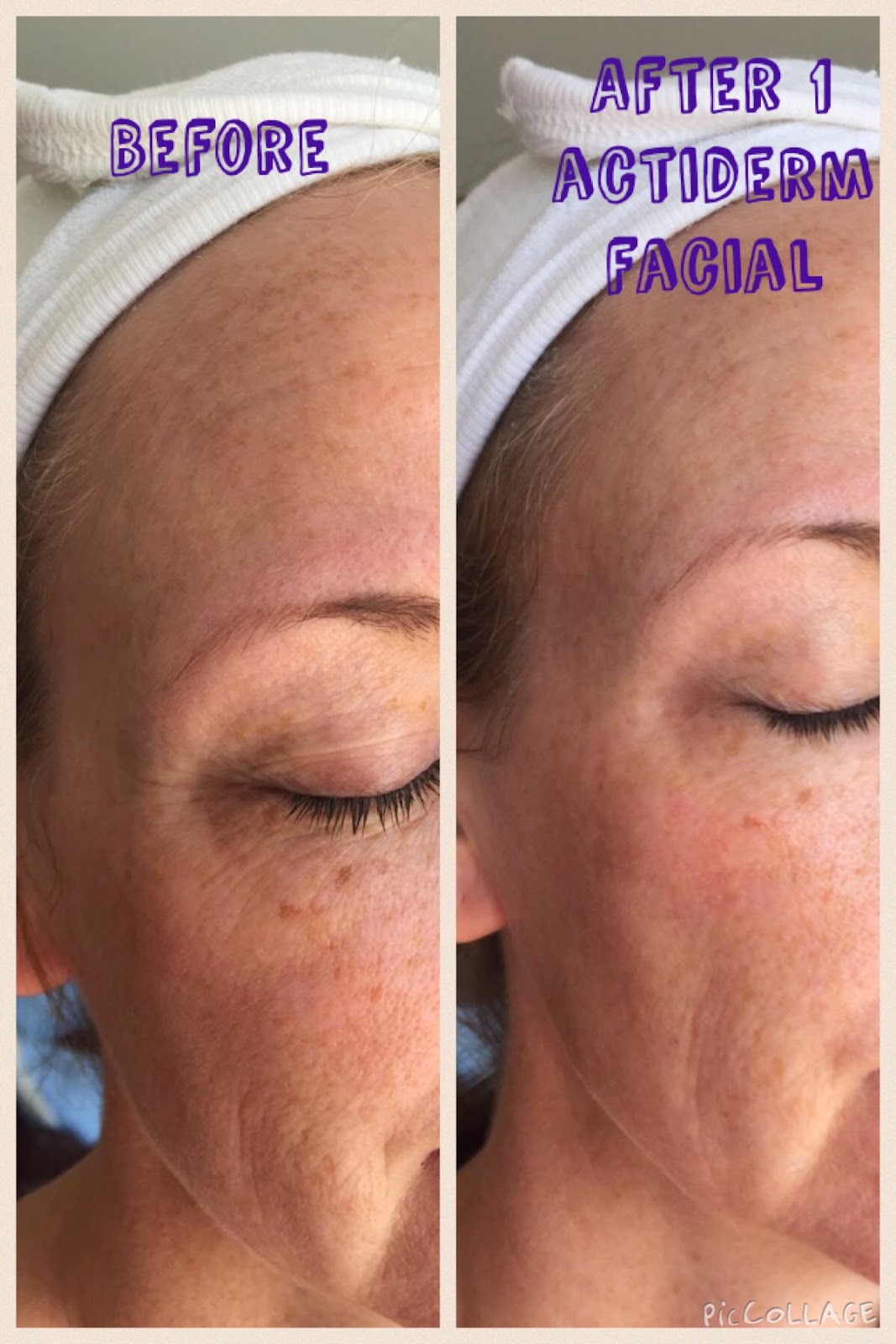 Mrs G's pro beauty diary: Actiderm Facial review