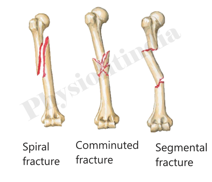 Types of Fracture,symptoms,Healing stages,Management,Physiotherapy ...