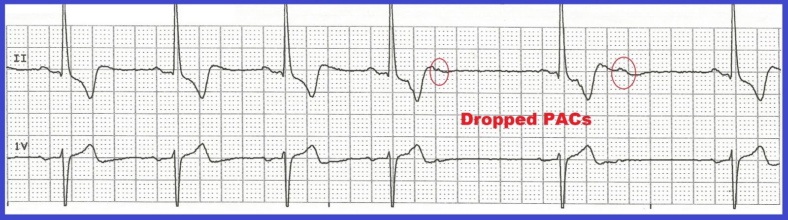Practice EKG Rhythm Strips 152