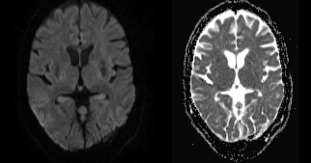 Ultimate Radiology : Diffusion negative Acute Infarct !! (False ...