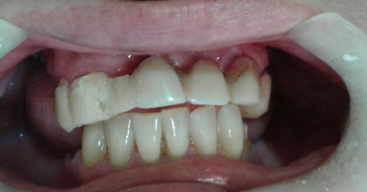 Caso Clínico de prótese fixa