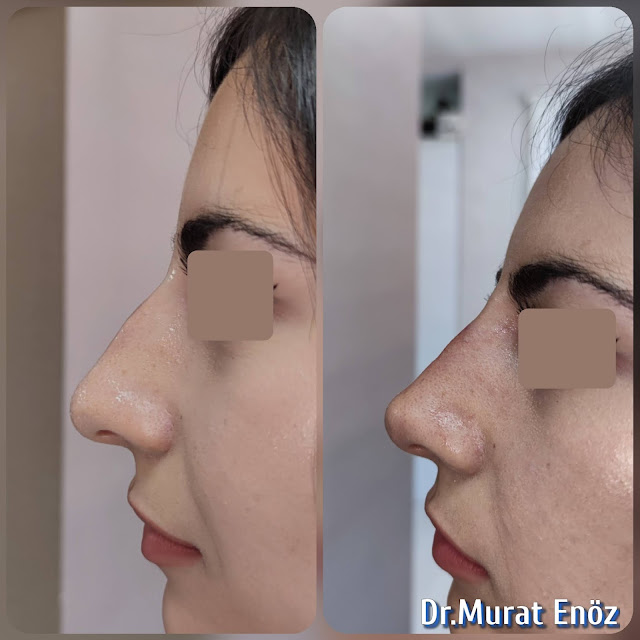 5 Minutes Nose Job With Filler in Istanbul