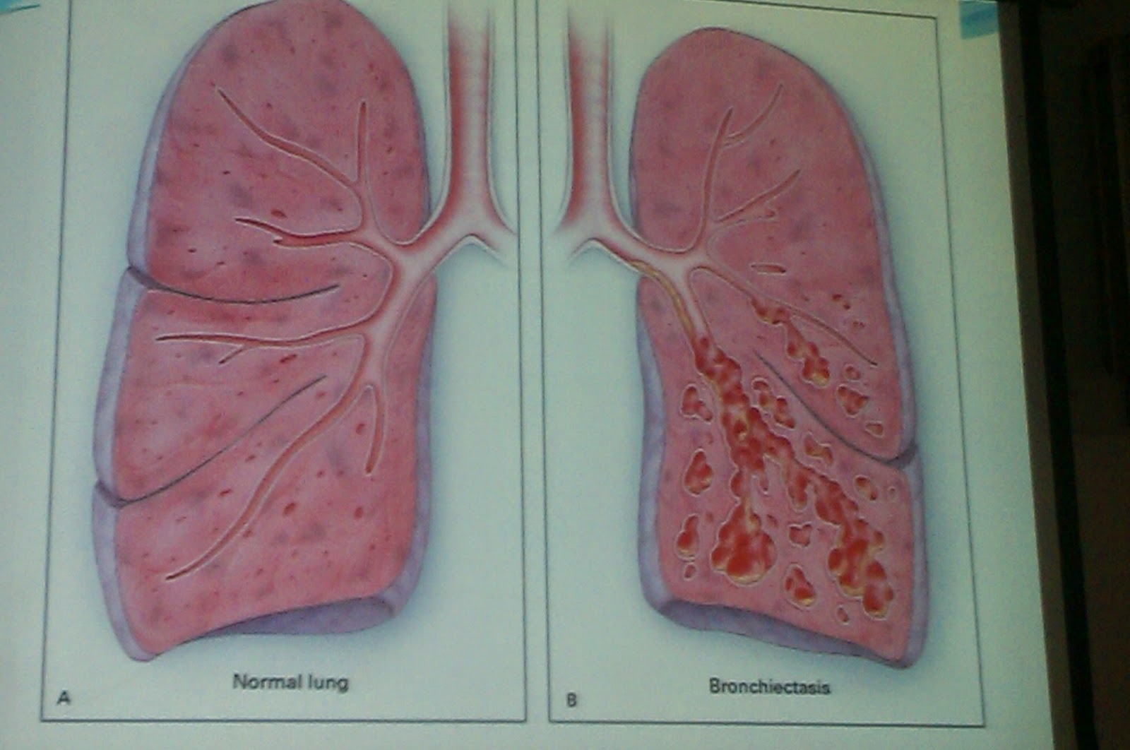 Lecture Slides; TB & CD: Bronchiectasis