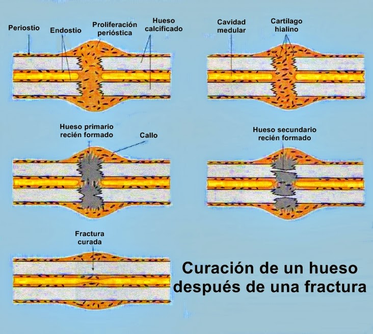 Curación de un hueso después de una fractura