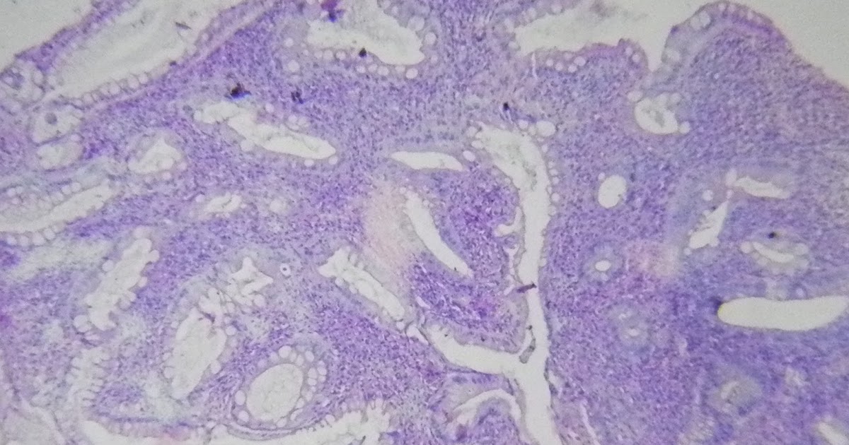 into the roots: Endoscopic biopsy of gastro intestinal tract