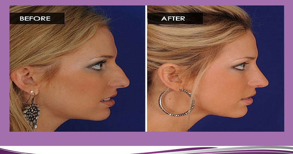 Septoplasty in Mumbai