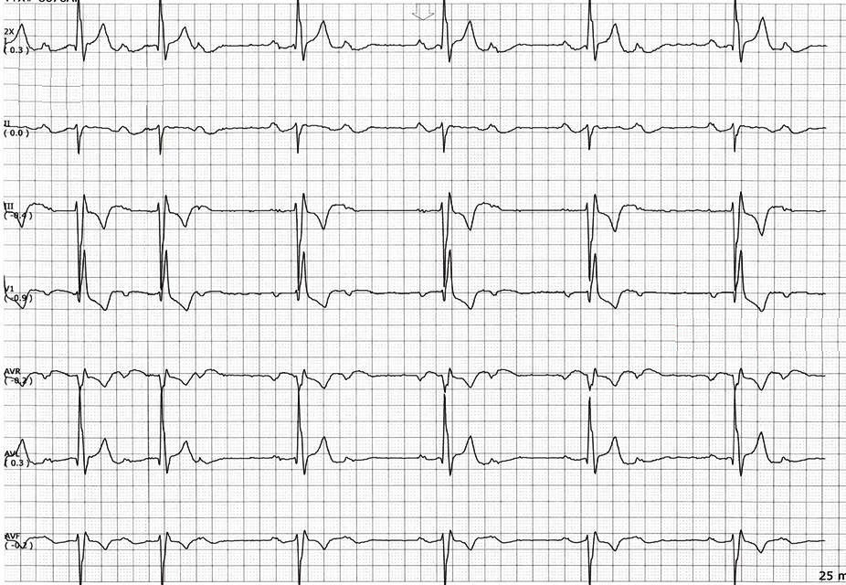 ECG Rhythms: A 2:1 AV block is not right away a Mobitz II