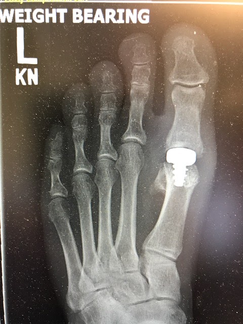 Foot and Ankle Problems By Dr. Richard Blake: Cartiva Joint Implant vs ...