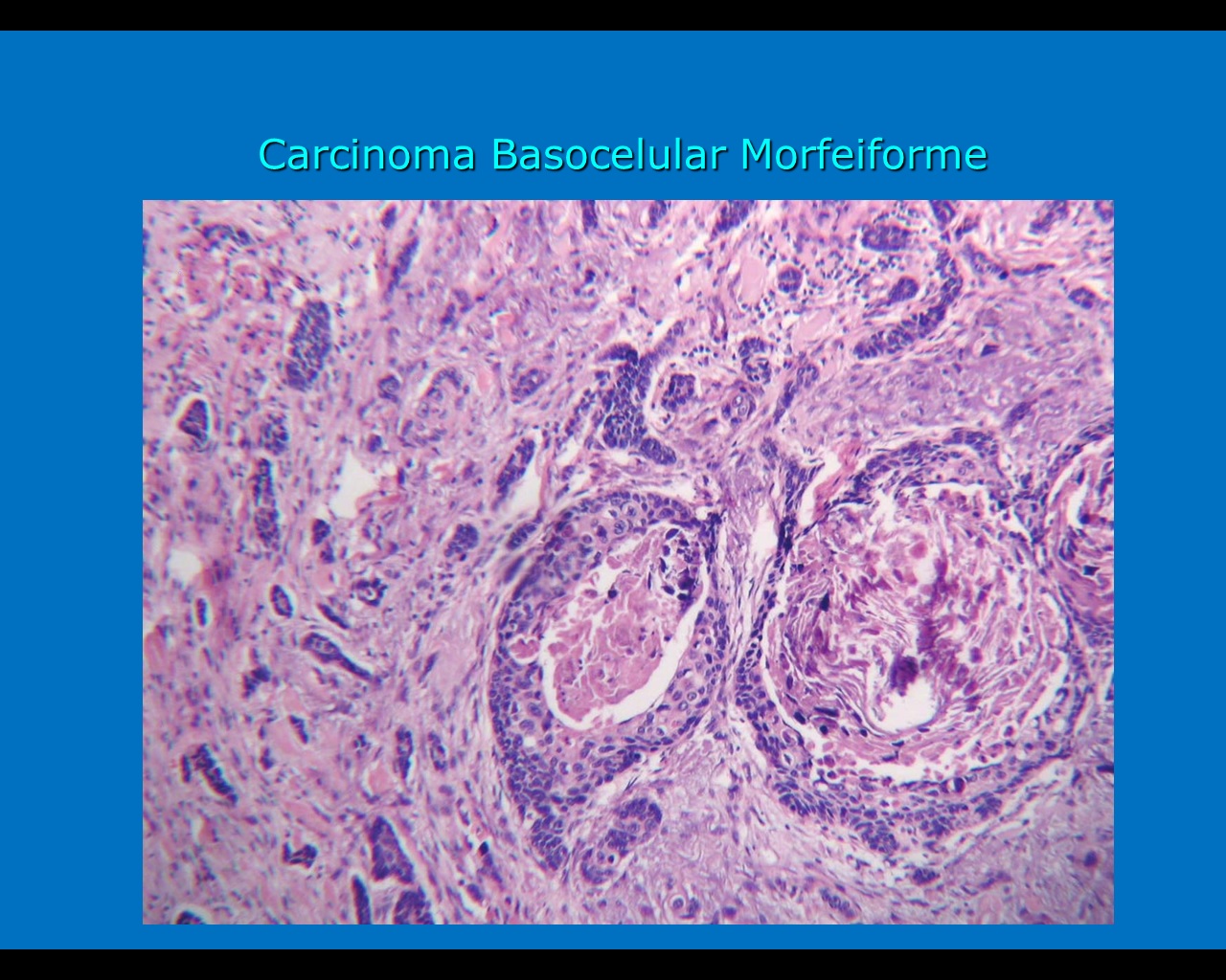 Dermatopatologia: CARCINOMA BASOCELULAR
