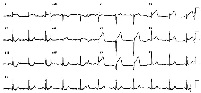 Opiniones de Infarto de miocardio con elevación del segmento ST