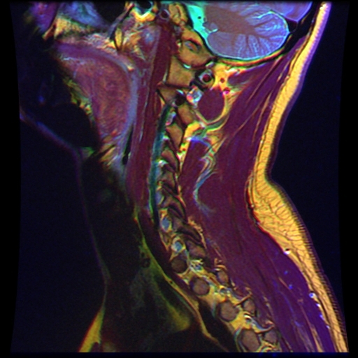 Nevit's blog: Color MRI of Cervical vertebrae