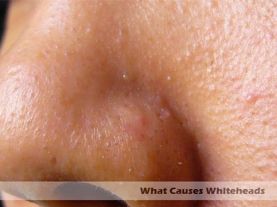 What Causes Whiteheads and Treatment | Hormonal Acne Tips